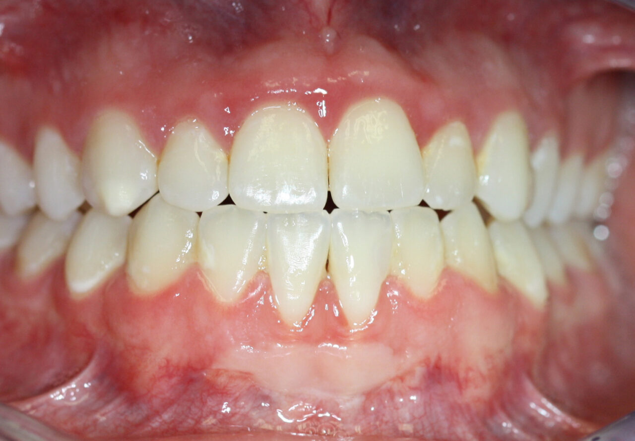 Periodontal Soft Tissue Grafting | Tyler Periodontics