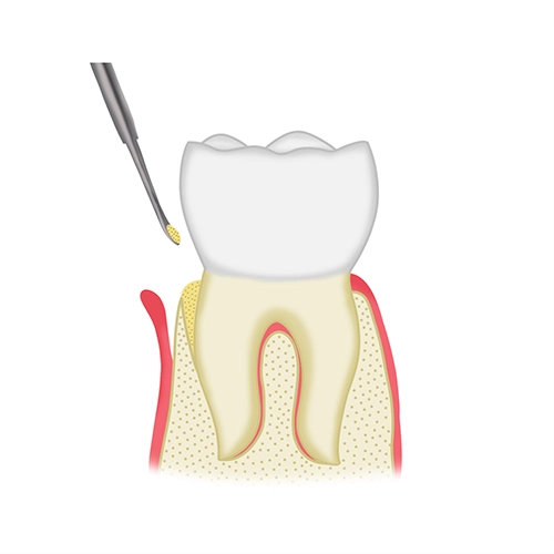 Bone Grafting | Tyler Periodontics
