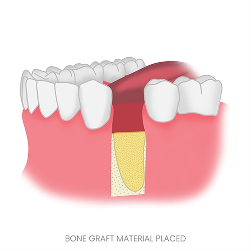 Tooth Extractions | Tyler Periodontics