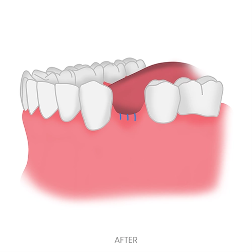 Tooth Extractions | Tyler Periodontics