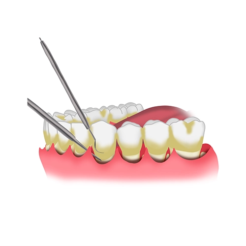 Periodontal Flap Surgery | Tyler Periodontics